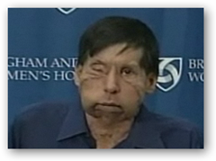 2nd Facial Transplant Patient Makes Public Appearance – Brigham and ...
